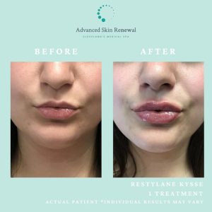 Before and After Gallery | Advanced Skin Renewal - Westlake OH